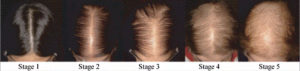 Female pattern hair loss, biological ageing and the Leiden Longevity ...