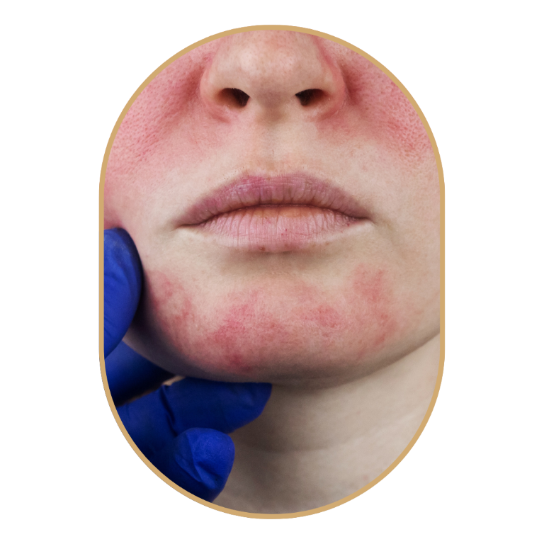 New content update on Rosacea - Sinclair Dermatology