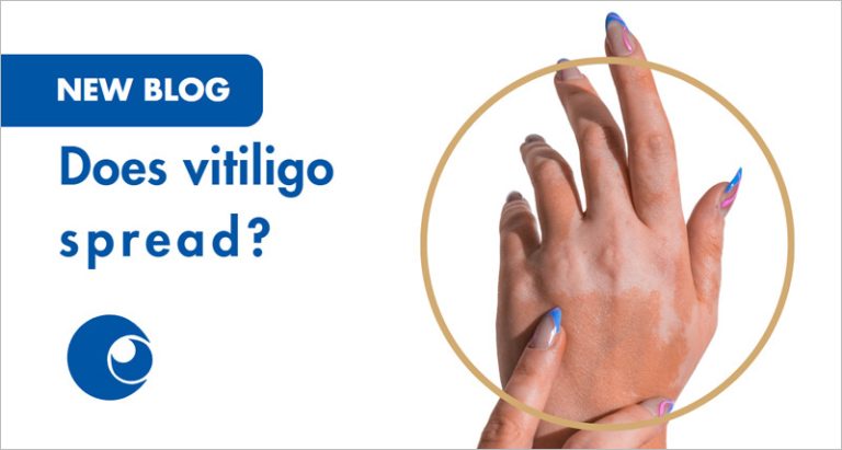 Vitiligo Causes, symptoms, and treatment insights - Sinclair Dermatology