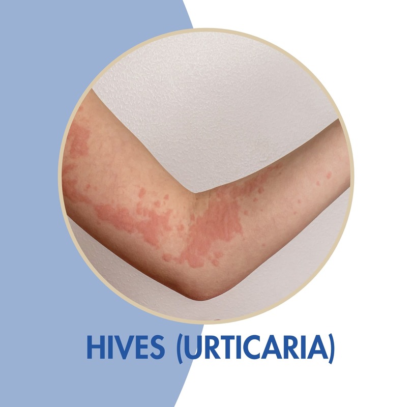 Chronic Spontaneous Urticaria – Adults - Sinclair Dermatology